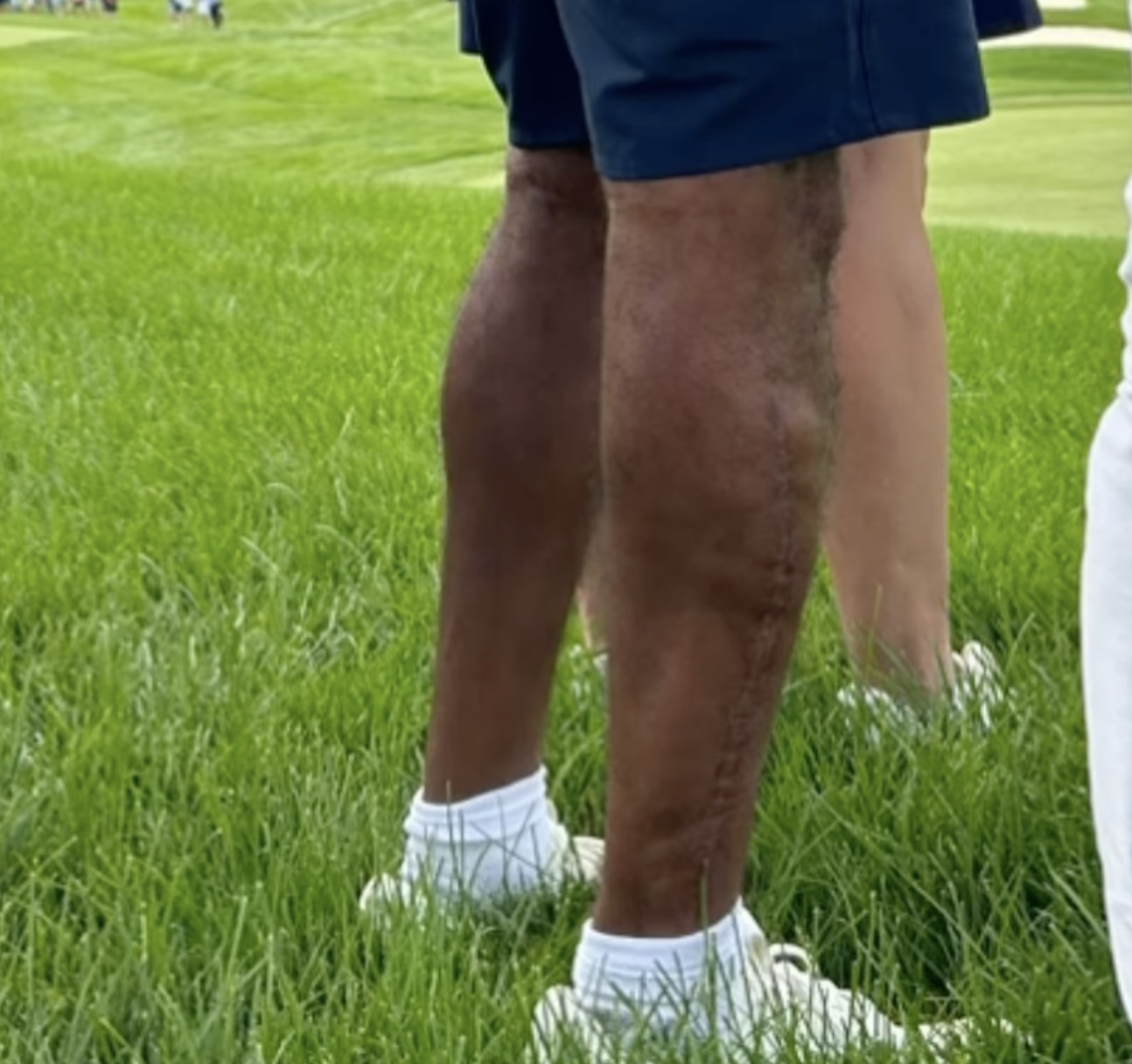 New photos show shocking extent of Tiger Woods' leg injuries | bunkered ...